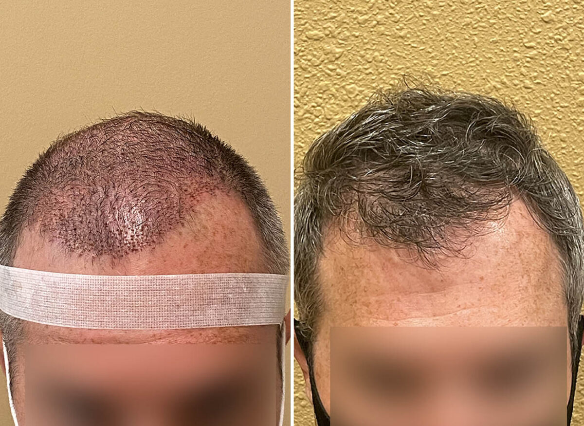 Male Fue Hair Transplant Cova Hair