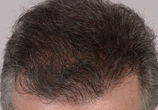Fut Hair Transplant Cova Hair
