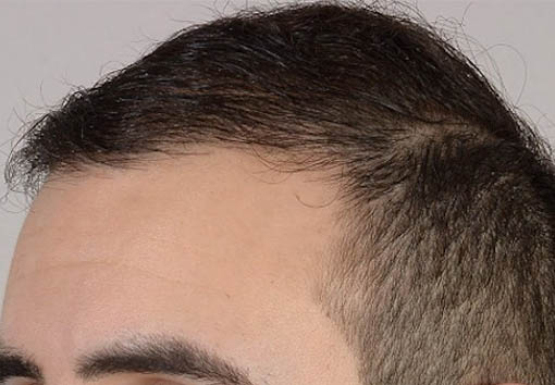 Fut Hair Transplant Cova Hair
