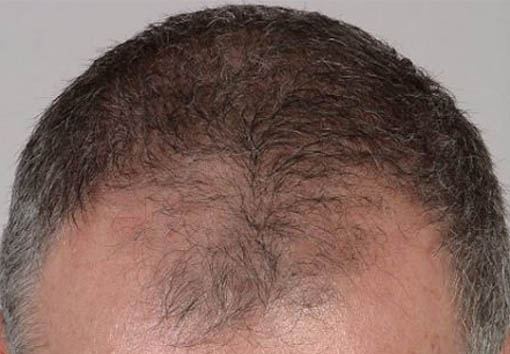 Fut Hair Transplant Cova Hair