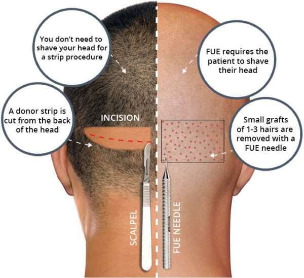 FUE vs. FUT Hair Transplants | Compare Techniques | Cova Hair