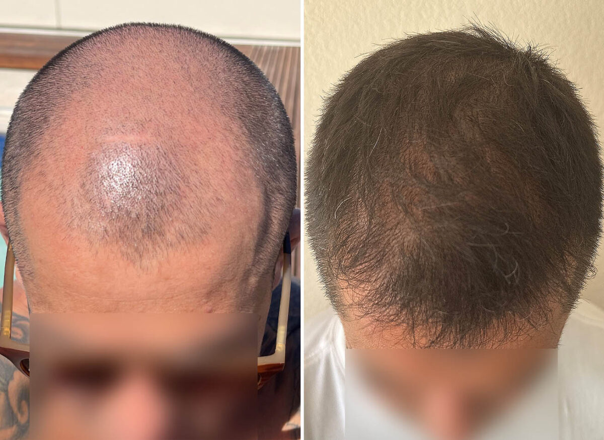 Male Fue Hair Transplant Cova Hair